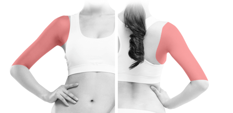 Arm Liposuction For Sleek and Sculpted Arms – Lydian Clinic